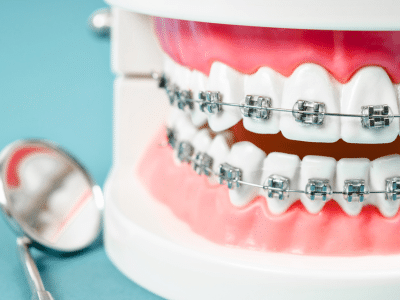 Getting Invisalign Braces In Toronto | Wired Orthodontics
