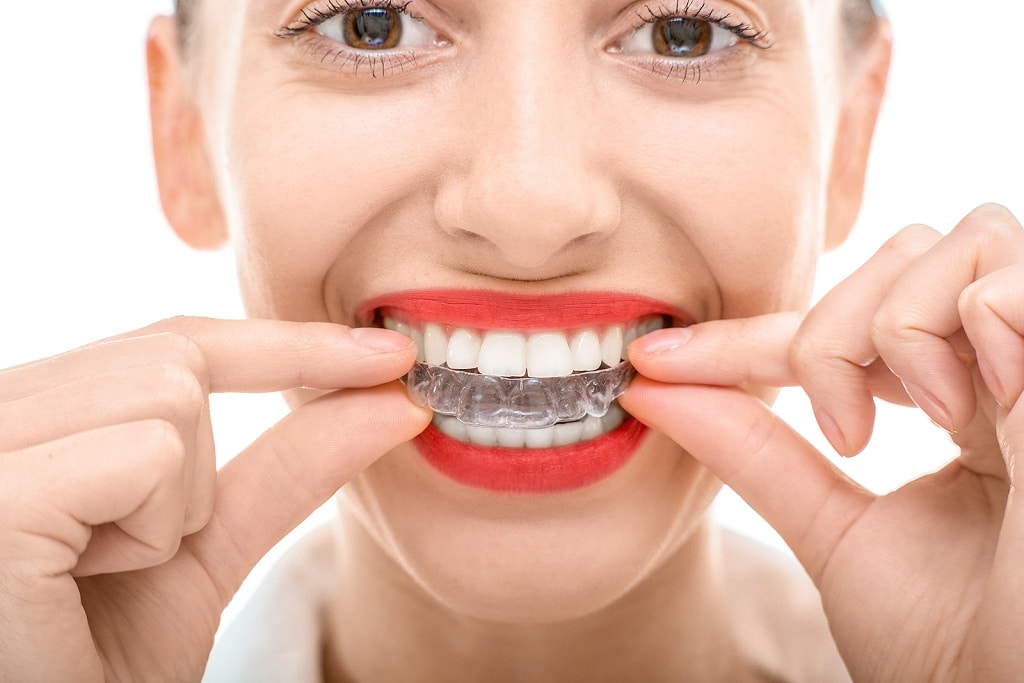 Diamond Plus Invisalign Provider | Wired Orthodontics
