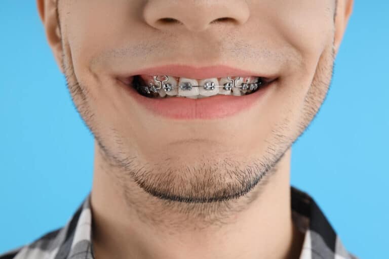 Braces Markham: Top 5 Foods To Avoid After Getting Braces